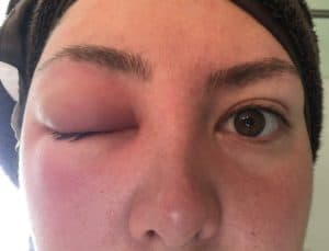 Understanding Bee Stings & Allergic Reactions - Heritage Acres Market LLC